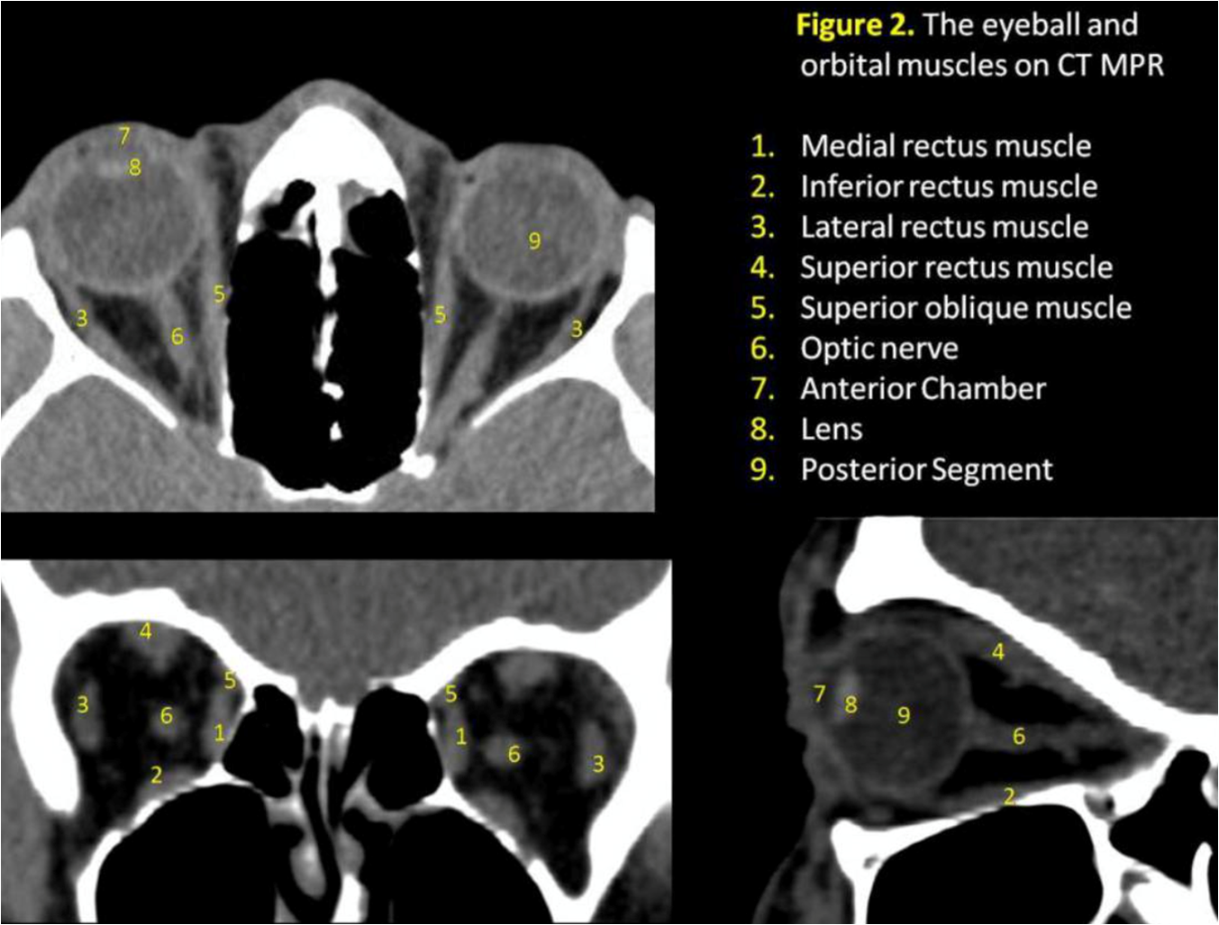 KỸ THUẬT VÀ MỘT SỐ BỆNH LÝ TRÊN CLVT CHẤN THƯƠNG MẮT | Trung tâm chẩn ...